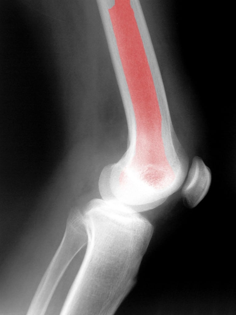 Knee Disability: When to File for Social Security Disability Benefits